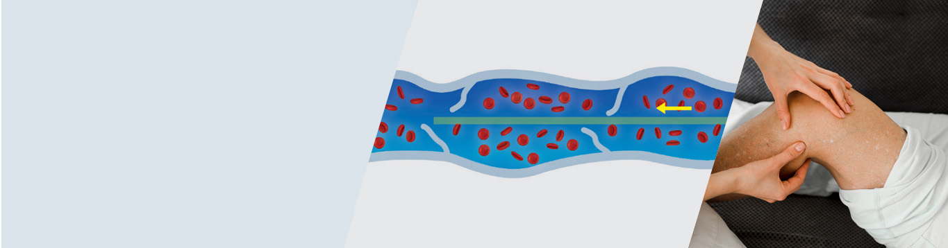 Glue Treatment For Varicose Veins | Venaseal Treatment | VeinExperts